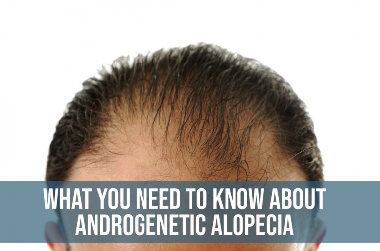 What You Need to Know About Androgenetic Alopecia - LA FUE Hair Clinic ...